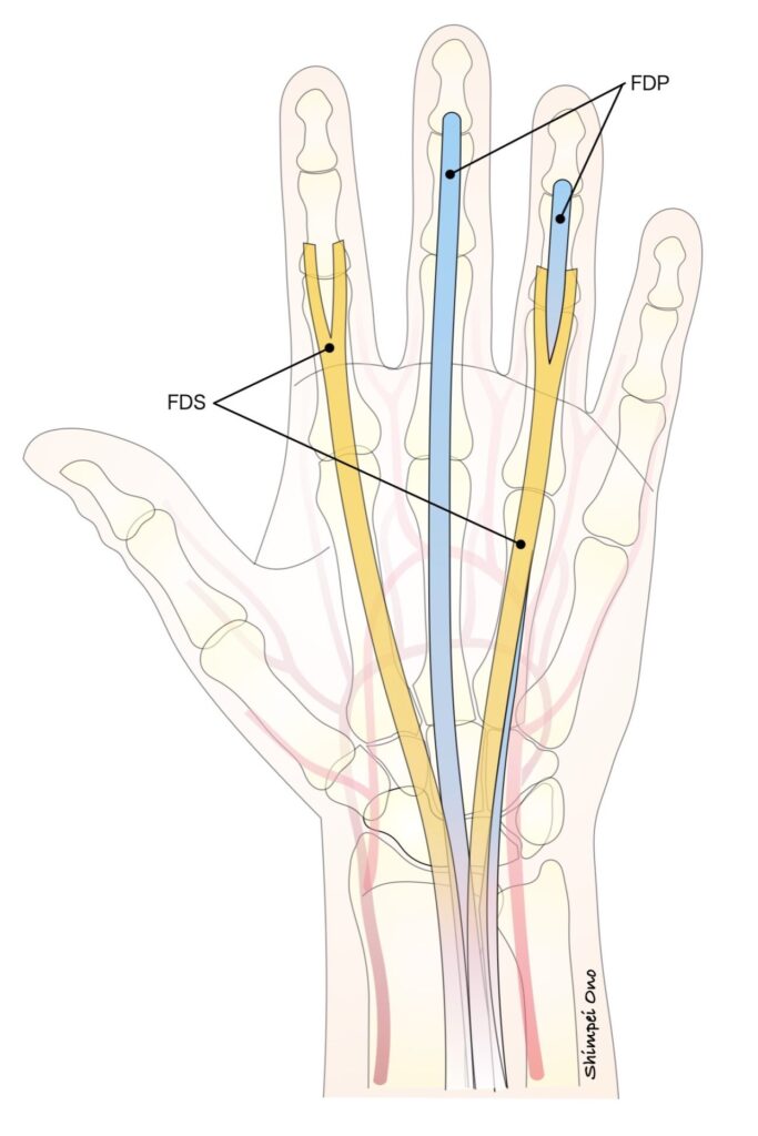 【診療Tips】FDS・FDP腱断裂の診断とFDS/FDPテスト：ERで必ず確認すべき指診察のポイント - マイナー外科・救急