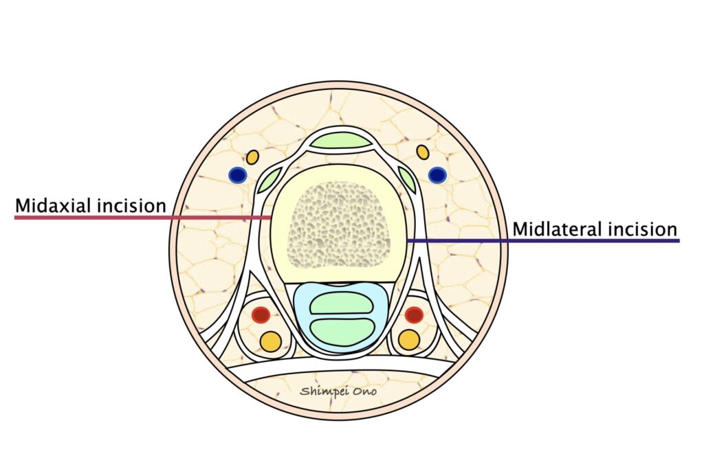 【診療Tips】手指手術の切開法：Bruner's incision、Midlateral incision - マイナー外科・救急