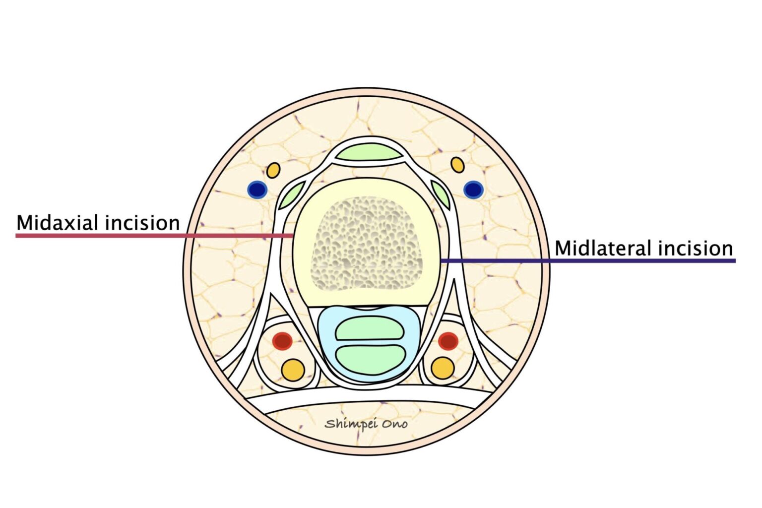 【診療Tips】手指手術の切開法：Bruner's incision、Midlateral incision - マイナー外科・救急
