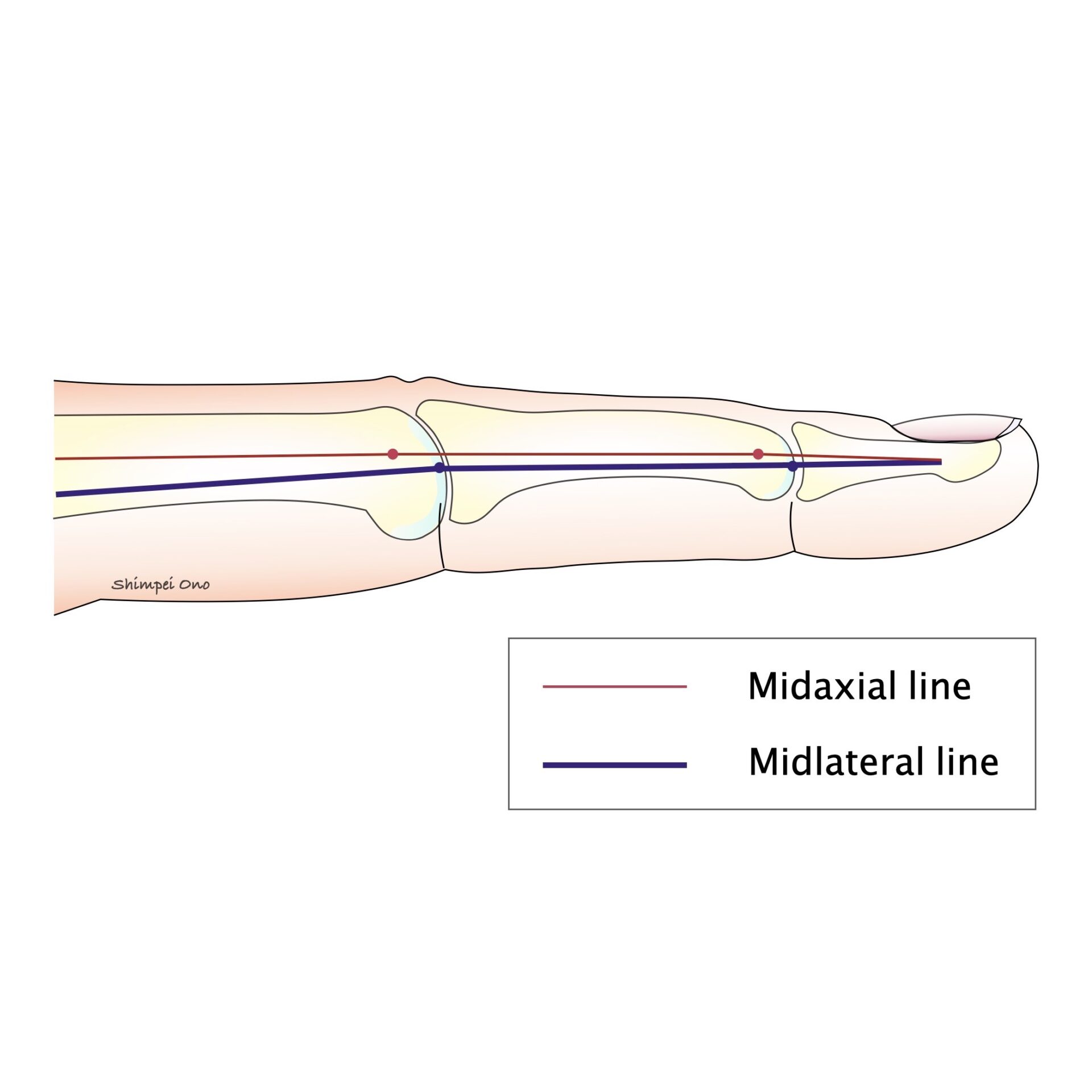【診療Tips】手指手術の切開法：Bruner's incision、Midlateral incision - マイナー外科・救急