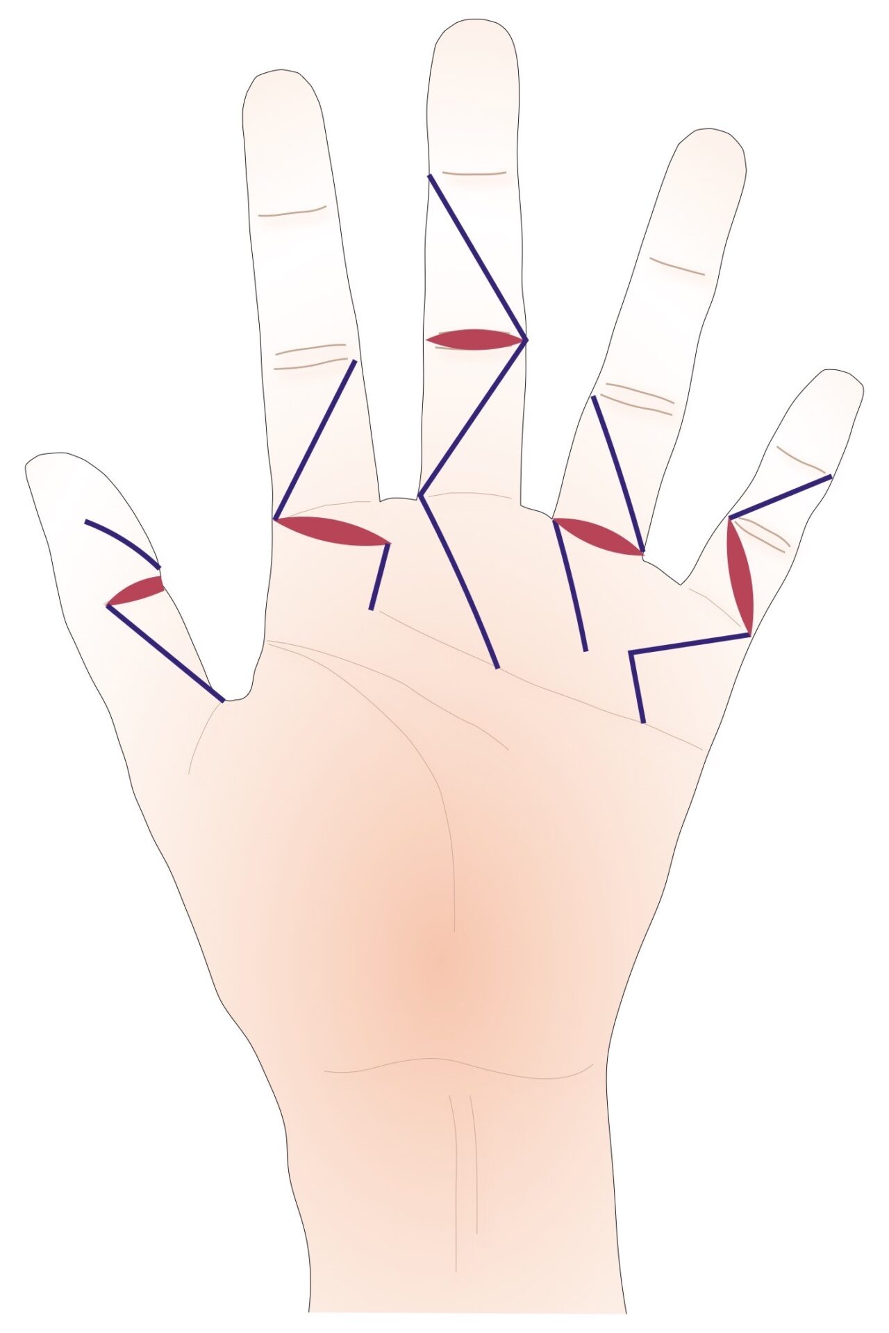 【Free illustrations】Bruner's incision, Midlateral incision, Midaxial ...