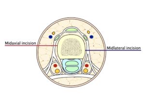 【Free illustrations】Bruner's incision, Midlateral incision, Midaxial ...