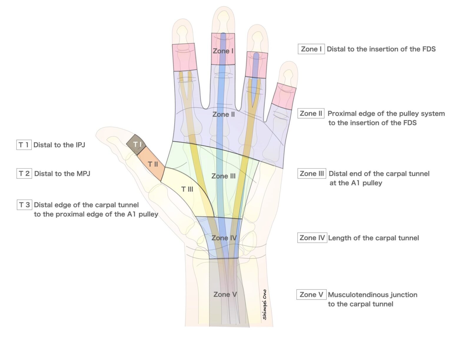 【Step by Step 手術手技】腱断裂（zone II）に対する屈筋腱縫合 - マイナー外科・救急