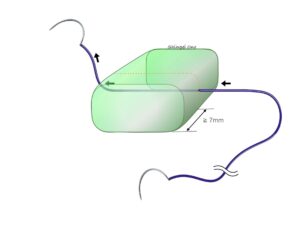 【診療Tips】Modified Kessler suture technique - マイナー外科・救急