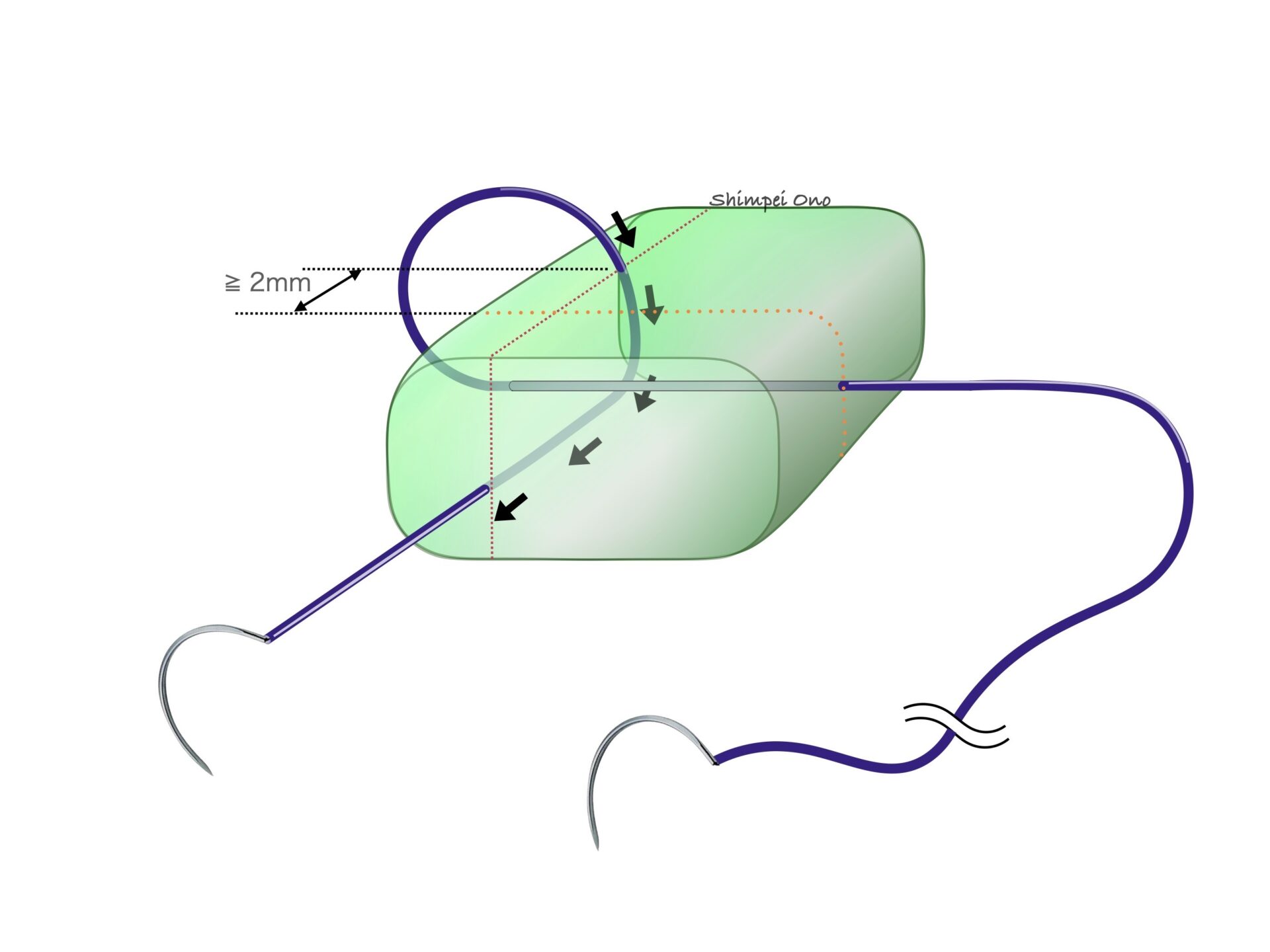 【診療Tips】Modified Kessler suture technique - マイナー外科・救急