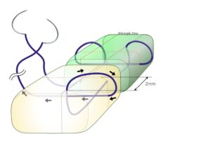 【診療Tips】Modified Kessler suture technique - マイナー外科・救急