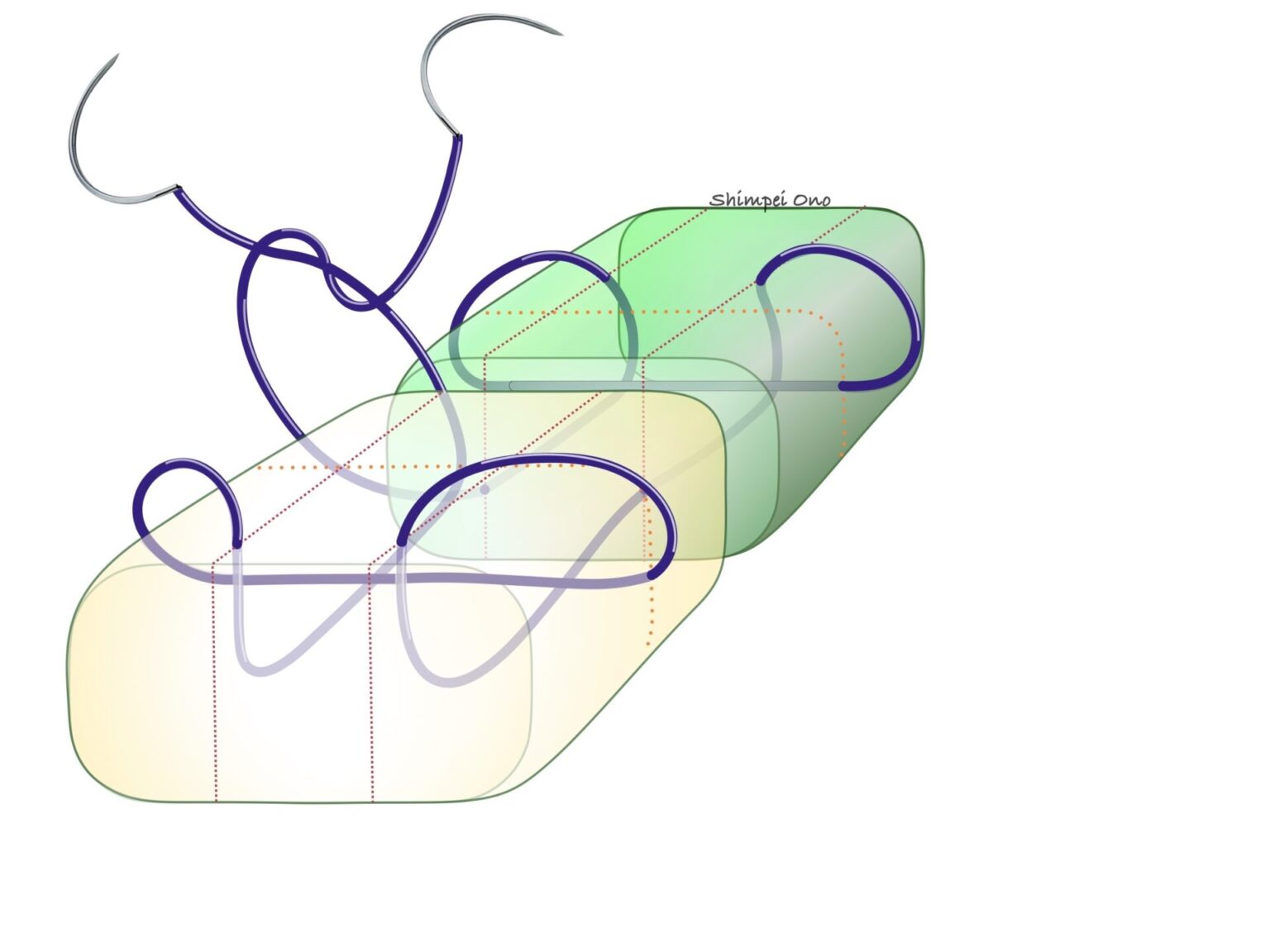 【診療Tips】Modified Kessler suture technique - マイナー外科・救急