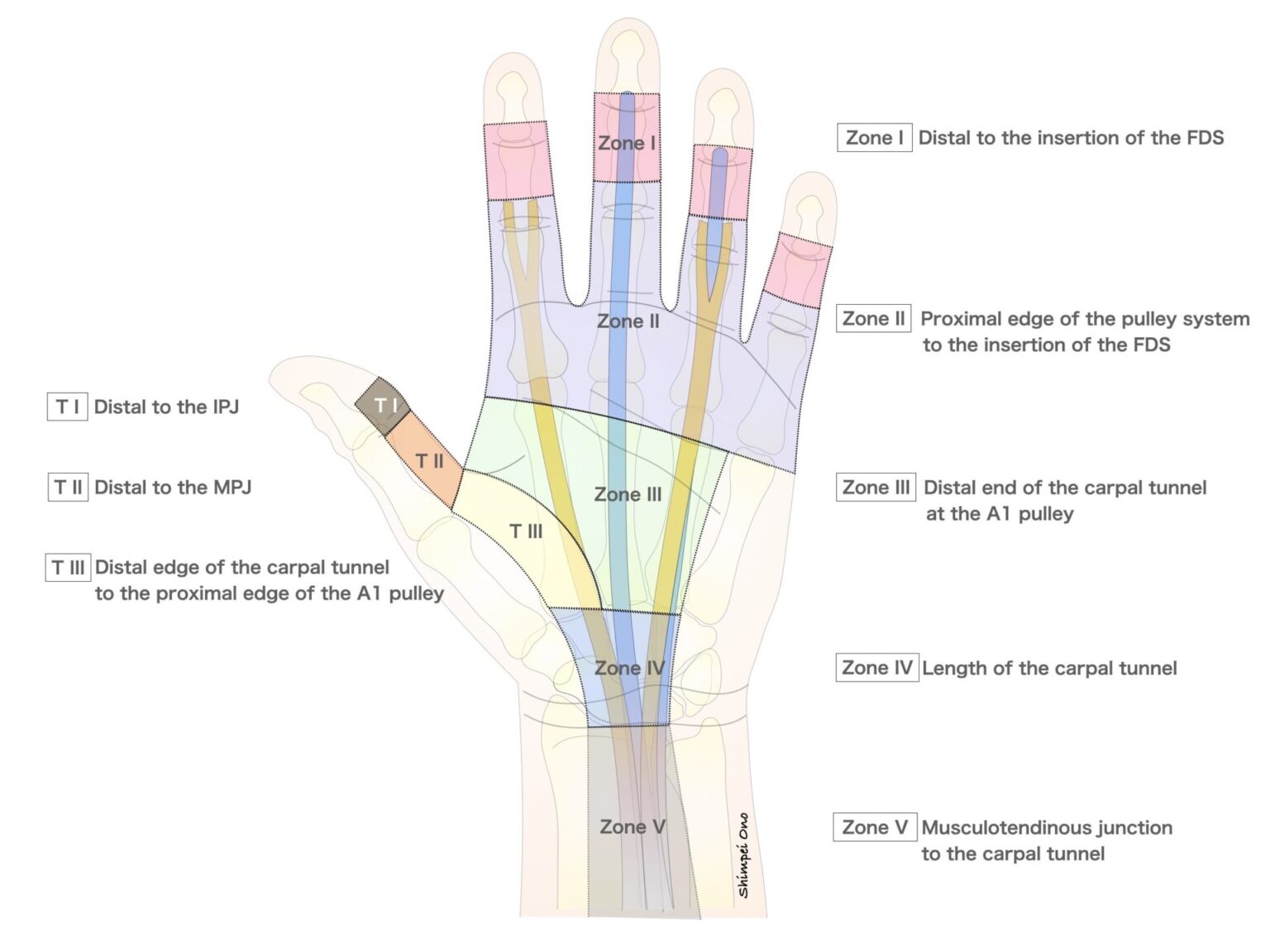 【診療Tips】腱の損傷部位による国際分類（zone分類） - マイナー外科・救急