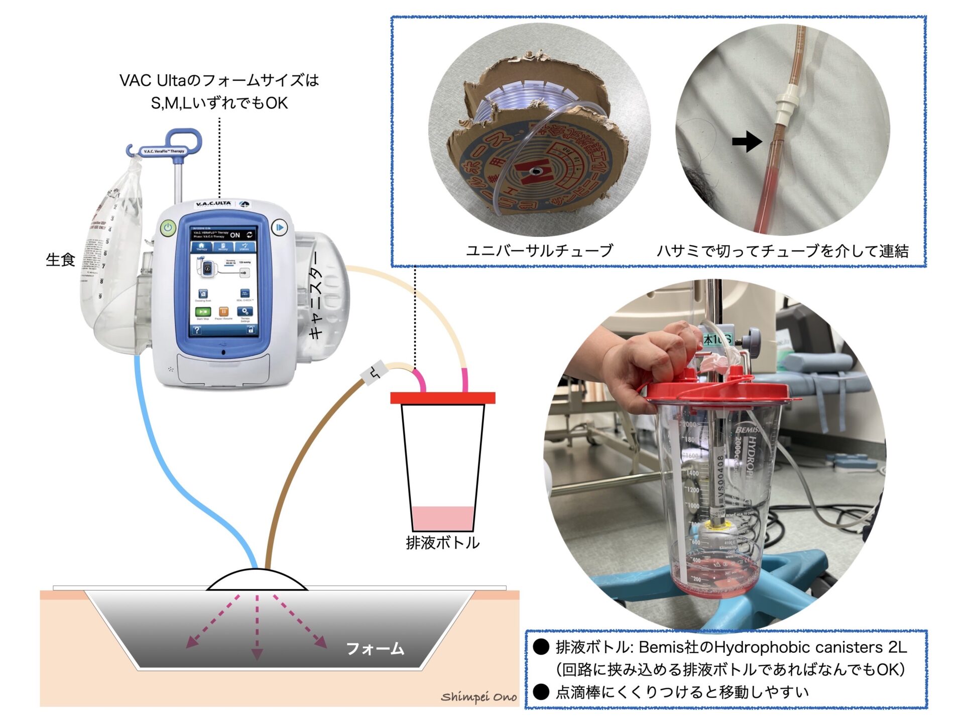 【診療Tips】大量洗浄可能なNPWT-id - マイナー外科・救急